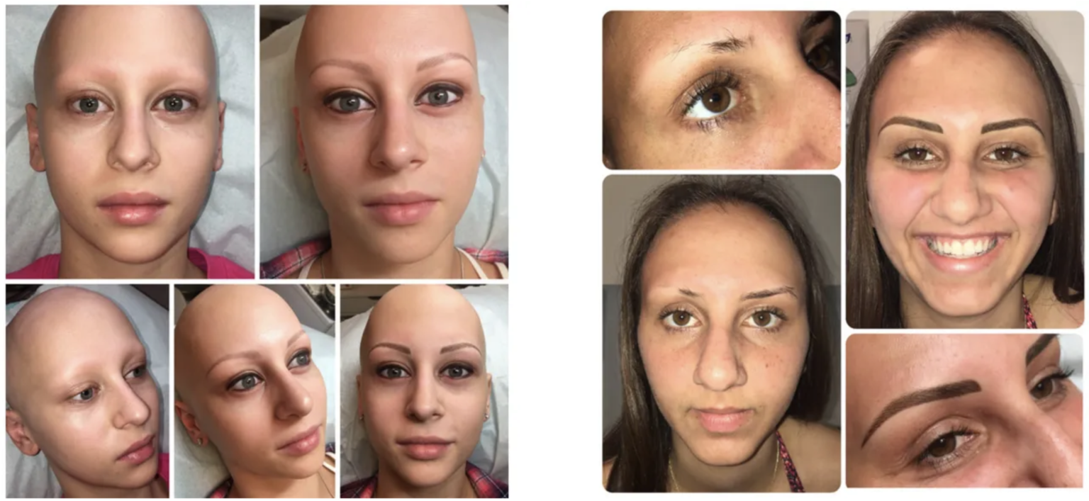 Medical Micropigmentation Procedures – Purebeau USA